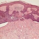 Nevus sebaceus - Altmeyers Encyclopedia - Department Dermatology
