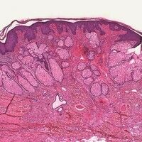 Naevus sebaceus Bilder - Altmeyers Enzyklopädie - Fachbereich Dermatologie