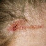 Nevus sebaceus - Altmeyers Encyclopedia - Department Dermatology