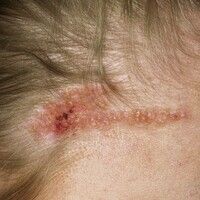 Naevus sebaceus Bilder - Altmeyers Enzyklopädie - Fachbereich Dermatologie