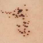 Naevus spilus - Altmeyers Enzyklopädie - Fachbereich Dermatologie