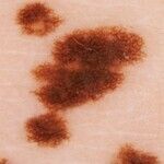 Nevus spilus - Altmeyers Encyclopedia - Department Dermatology