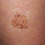 Nevus spilus - Altmeyers Encyclopedia - Department Dermatology
