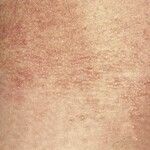 Elastic nevus - Altmeyers Encyclopedia - Department Dermatology