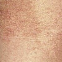 Naevus elasticus Bilder - Altmeyers Enzyklopädie - Fachbereich Dermatologie