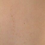 Epidermal nevus (overview) - Altmeyers Encyclopedia - Department ...