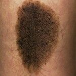 Nevus pigmentosus et pilosus - Altmeyers Encyclopedia - Department ...