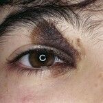 Nevus pigmentosus et pilosus - Altmeyers Encyclopedia - Department ...