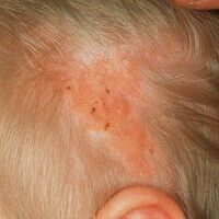 Naevus sebaceus Bilder - Altmeyers Enzyklopädie - Fachbereich Dermatologie