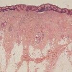 Nevus sebaceus - Altmeyers Encyclopedia - Department Dermatology