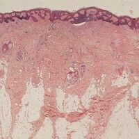 Naevus sebaceus Bilder - Altmeyers Enzyklopädie - Fachbereich Dermatologie