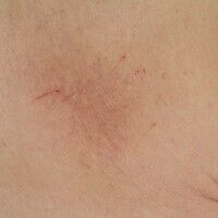 Notalgia paraesthetica Images - Altmeyers Encyclopedia - Department ...