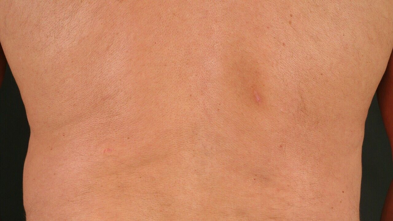 Notalgia Paresthetica Treatment