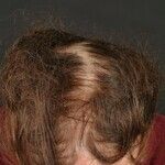 Ophiasis - Altmeyers Encyclopedia - Department Dermatology