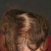 Ophiasis Bilder - Altmeyers Enzyklopädie - Fachbereich Dermatologie