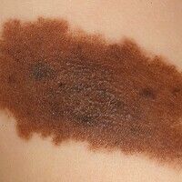 Naevus melanozytärer kongenitaler Images - Altmeyers Encyclopedia ...