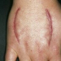 Narbe, hypertrophische Bilder - Altmeyers Enzyklopädie - Fachbereich ...