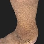 Papillomatosis cutis lymphostatica - Altmeyers Encyclopedia ...