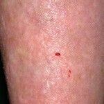 Papillomatosis cutis lymphostatica - Altmeyers Encyclopedia ...