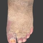 Papillomatosis cutis lymphostatica - Altmeyers Encyclopedia ...