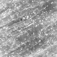 Parakeratose Bilder - Altmeyers Enzyklopädie - Fachbereich Dermatologie