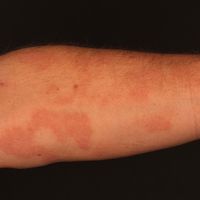 Parapsoriasis (overview) Images - Altmeyers Encyclopedia - Department ...