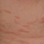 Parapsoriasis en plaques benign small foci - Altmeyers Encyclopedia ...