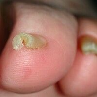 Pincers-nail Images - Altmeyers Encyclopedia - Department Dermatology