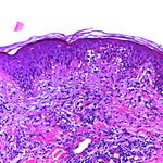 Pityriasis lichenoides chronica - Altmeyers Encyclopedia - Department ...