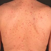 Pityriasis Lichenoides Et Varioliformis Acuta Images Altmeyers