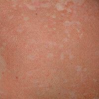 Pityriasis rubra pilaris (adult type) Images - Altmeyers Encyclopedia ...