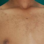 Pityriasis Grandiflora | Understanding Skin Conditions: Pityriasis ...