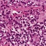 Pseudolymphomas of the skin (overview) - Altmeyers Encyclopedia ...