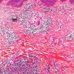 Pseudolymphomas of the skin (overview) - Altmeyers Encyclopedia ...