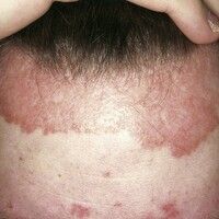 Psoriasis capitis Bilder - Altmeyers Enzyklopädie - Fachbereich ...
