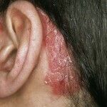 Psoriasis capitis - Altmeyers Enzyklopädie - Fachbereich Dermatologie
