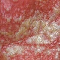 Bilder für Handfläche, Eiterbläschen/Eiterblase (Pustel) - Altmeyers ...