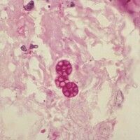 Protothecosis Images - Altmeyers Encyclopedia - Department Dermatology