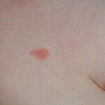 Prurigo simplex acuta - Altmeyers Encyclopedia - Department Dermatology