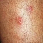 Prurigo simplex subacuta - Altmeyers Encyclopedia - Department Dermatology