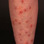 Prurigo simplex subacuta - Altmeyers Encyclopedia - Department Dermatology