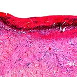 Prurigo simplex subacuta - Altmeyers Enzyklopädie - Fachbereich ...