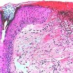 Prurigo simplex subacuta - Altmeyers Enzyklopädie - Fachbereich ...