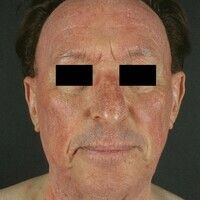 Actinic reticuloid Images - Altmeyers Encyclopedia - Department Dermatology