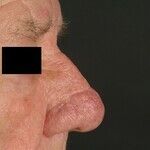 Rhinophym - Altmeyers Enzyklopädie - Fachbereich Dermatologie