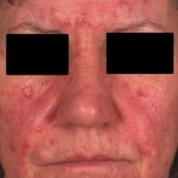 Rosazea (Übersicht) Bilder - Altmeyers Enzyklopädie - Fachbereich ...