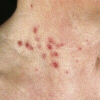 Pulicosis Images - Altmeyers Encyclopedia - Department Dermatology