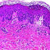 Pustel Bilder - Altmeyers Enzyklopädie - Fachbereich Dermatologie