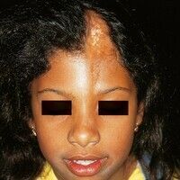 Scleroderma and coup de sabre Images - Altmeyers Encyclopedia ...