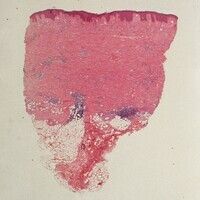 Scleroderma (overview) Images - Altmeyers Encyclopedia - Department ...